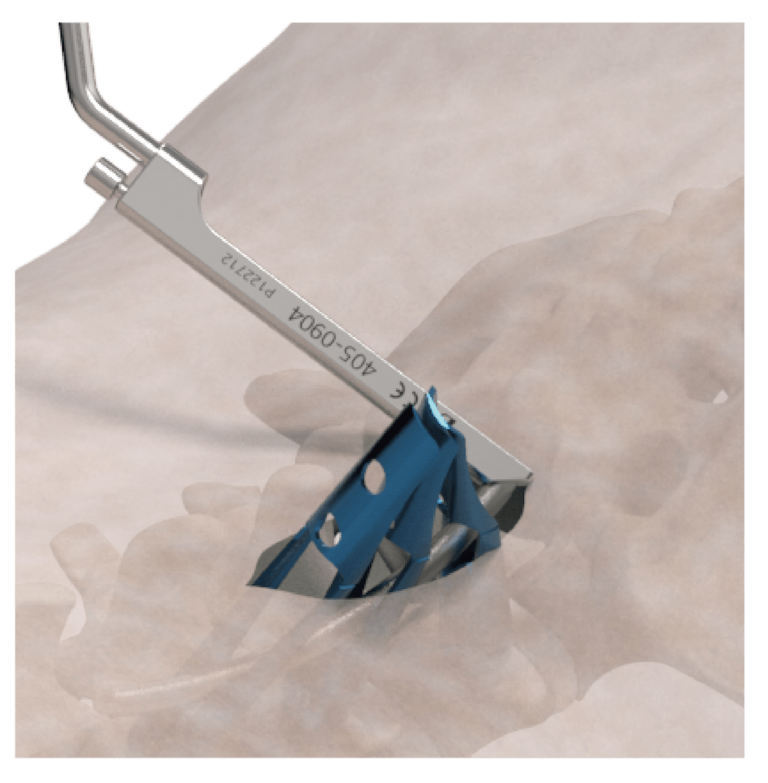 NOVA Minimally Invasive System | BAUI Biotech