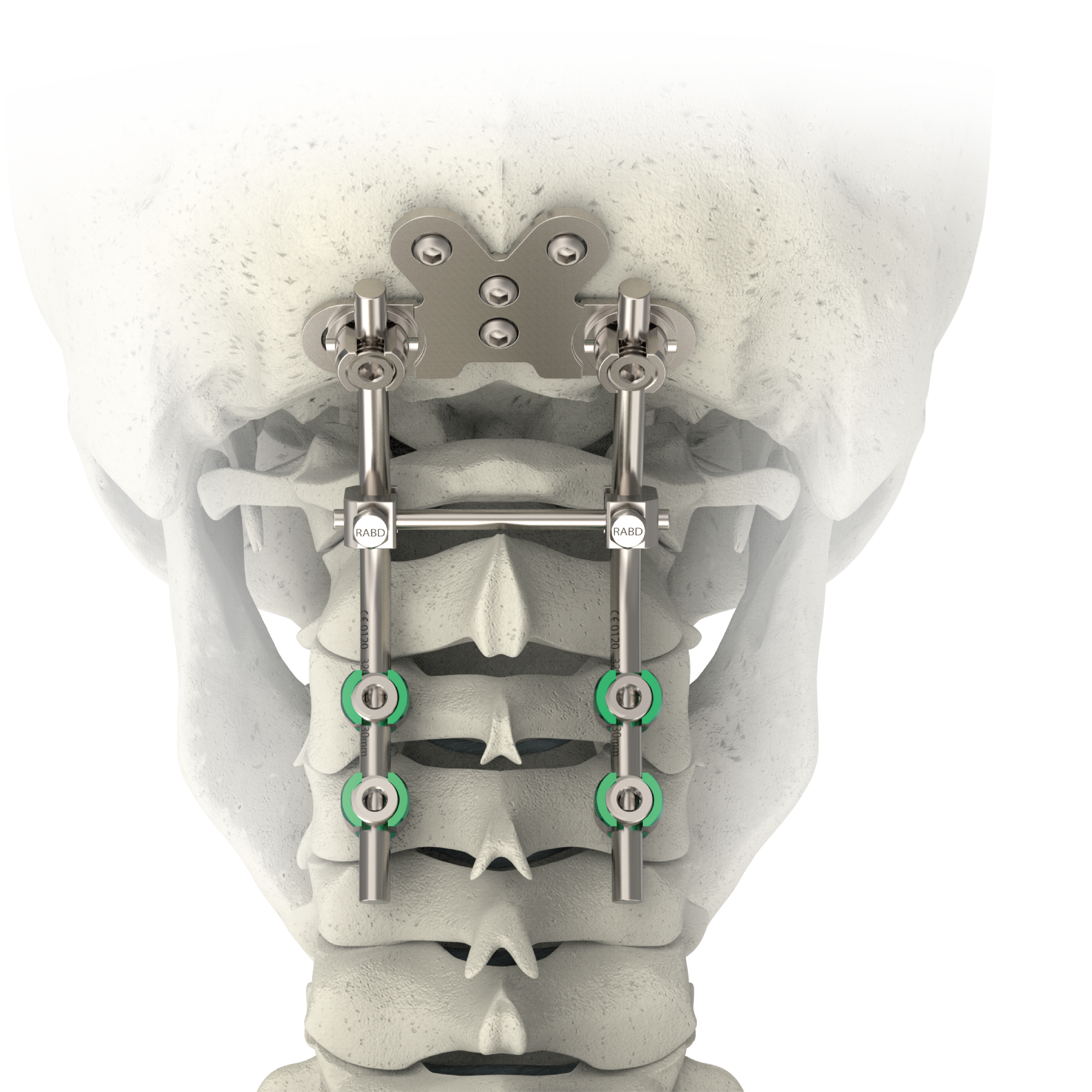 Posterior Cervical Fixation System | BAUI Biotech