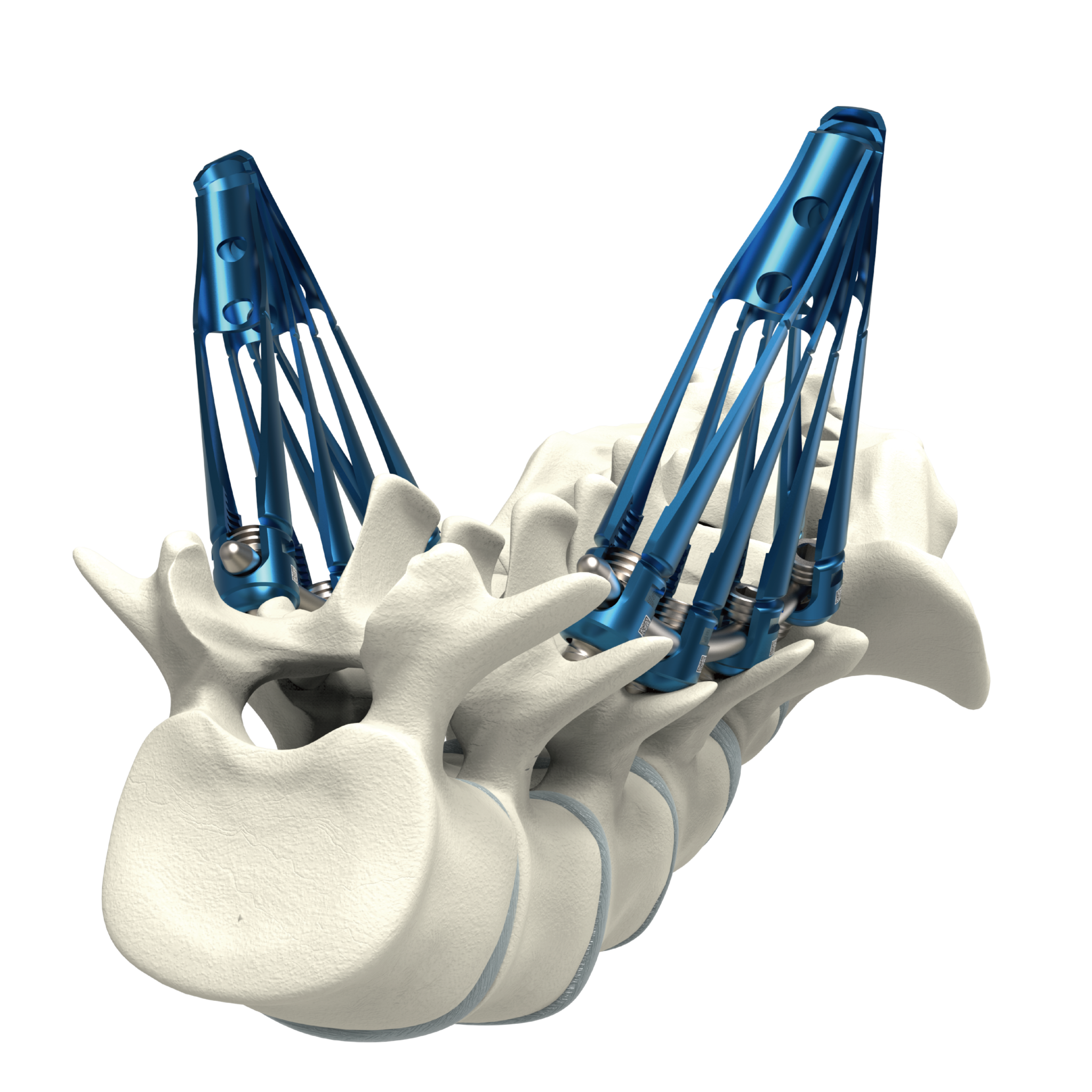 Lumbar Fixation System | BAUI Biotech