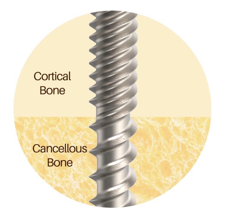 NOVA 2 Minimally Invasive System | BAUI Biotech