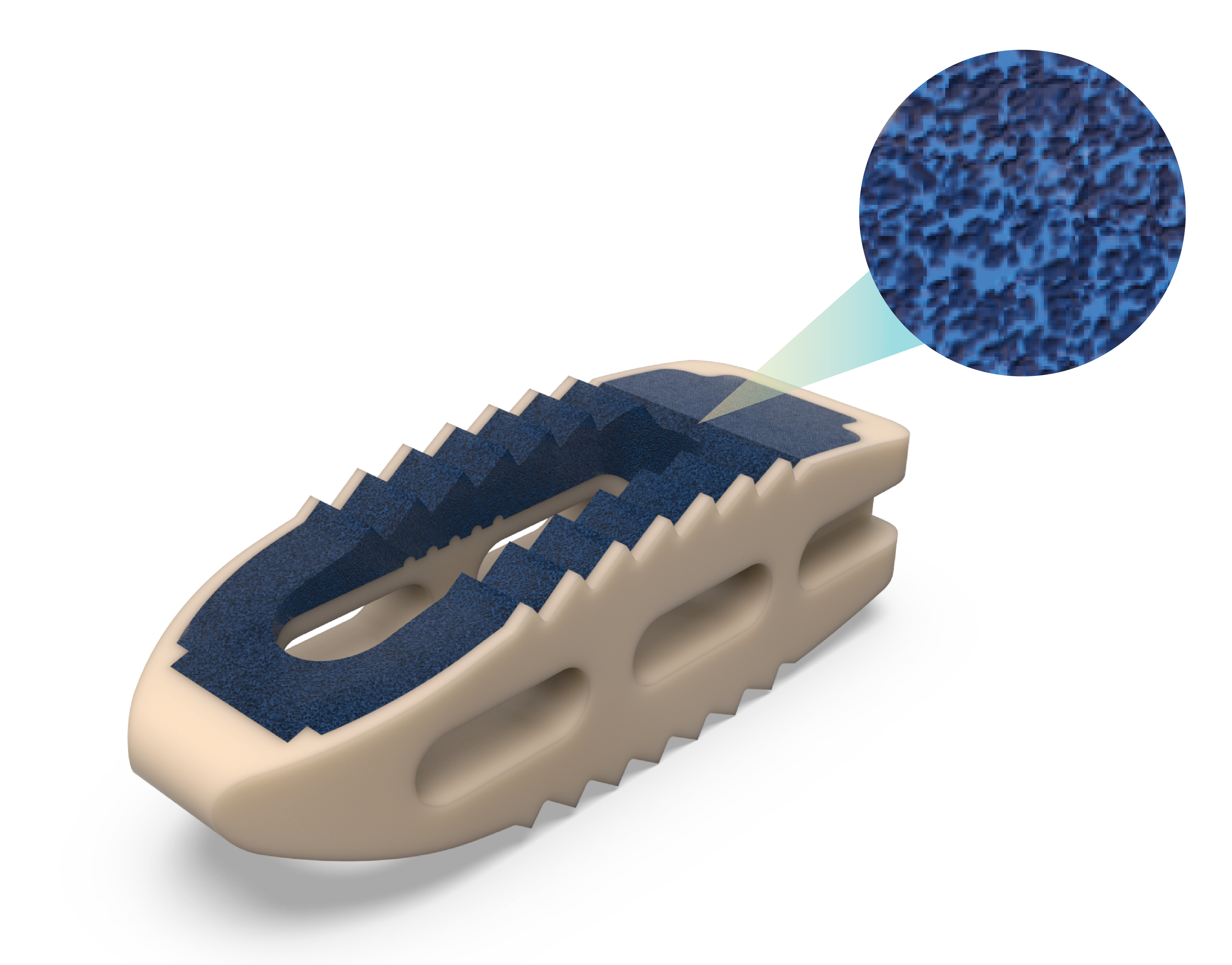 Canis Ti-PEEK Cage | BAUI Biotech