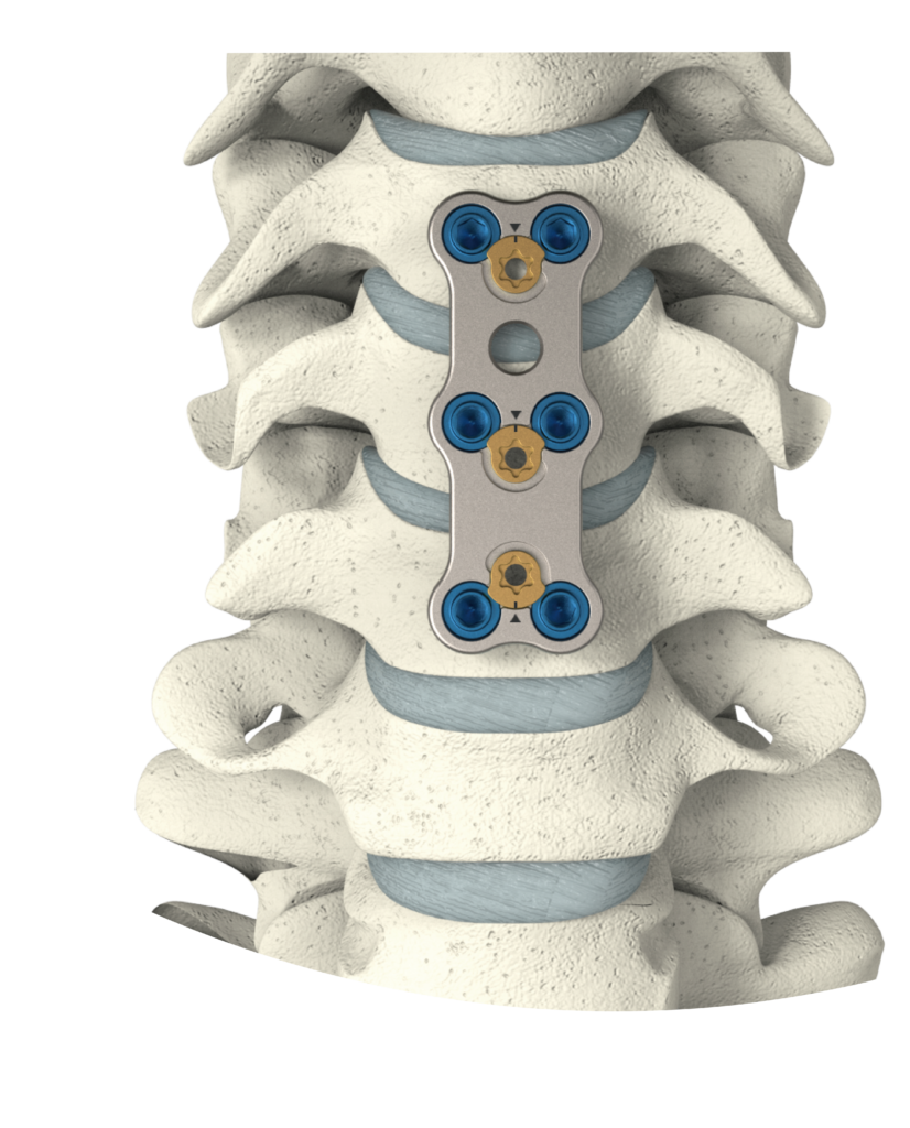 Anterior Cervical Plate | BAUI Biotech