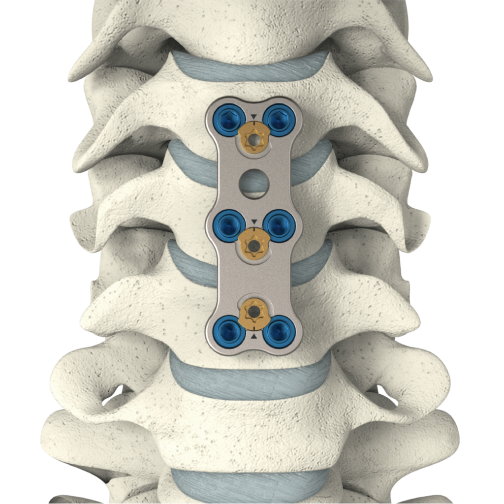 Cervical Fixation System | BAUI Biotech