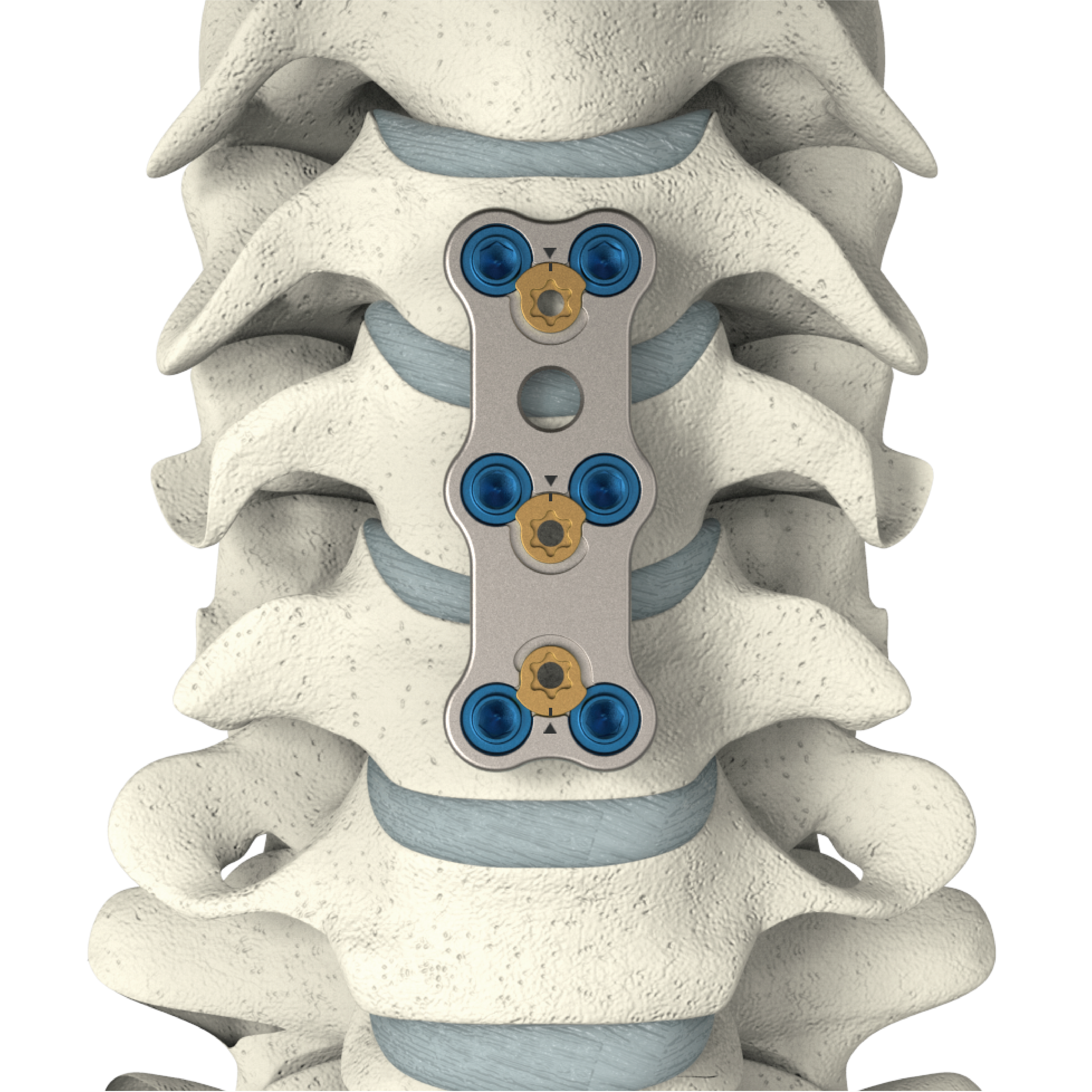 Cervical Fixation System | BAUI Biotech