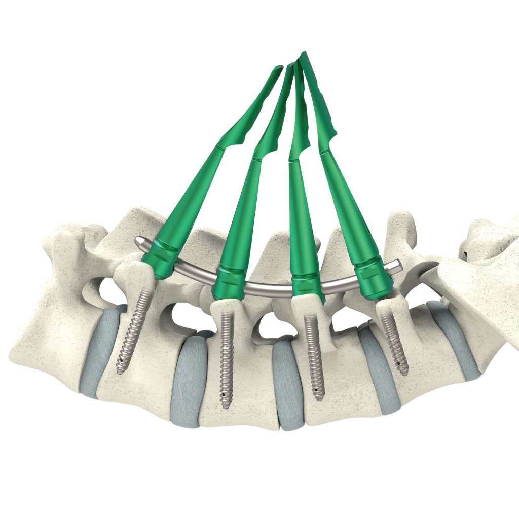 Pedicle Screw System | BAUI Biotech